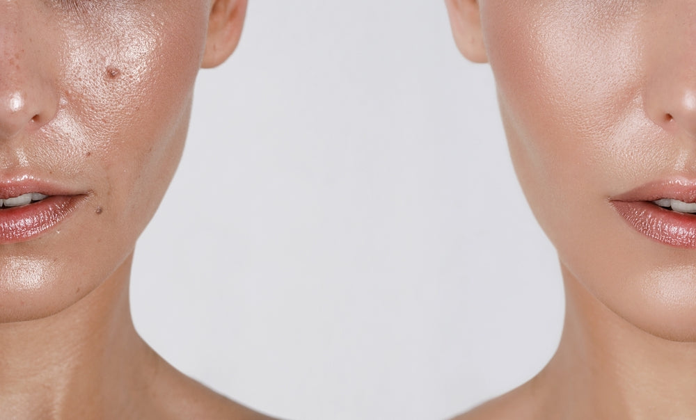 Dermatologist-Approved Tips for Managing Oily Skin - True Derma – Truederma